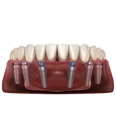 Dental Implants in Ahmedabad - Regain Your Perfect Smile Today