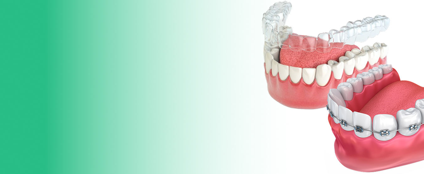 Are Clear Teeth Aligners better than Braces? Everything Parents Should Know