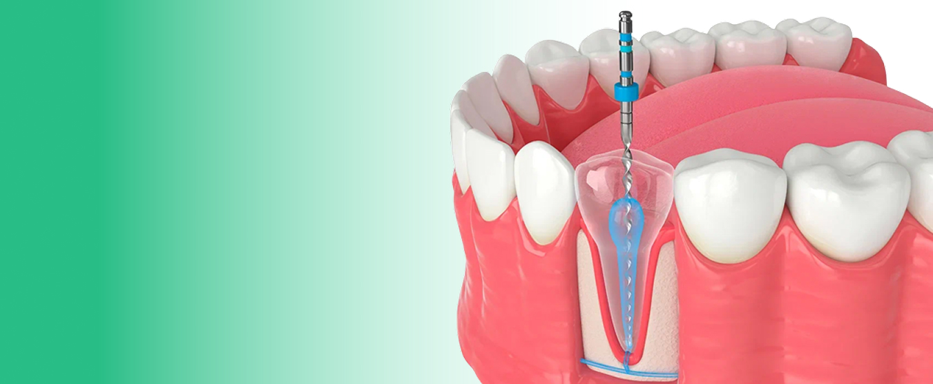 7 Signs You Need a Root Canal Treatment